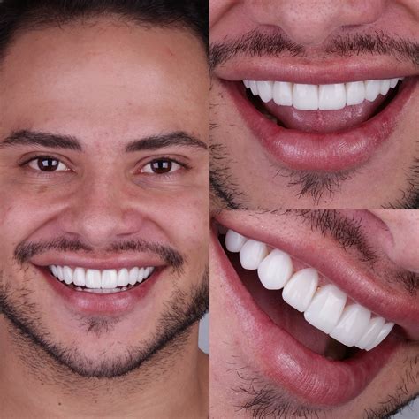 Mais Um Compilado De Fotos Desse Caso Só Pq Ficou IncrÍvel Cor Bl2 ♥️