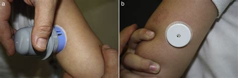 Dermatitis Alérgica De Contacto Al Adhesivo Del Sensor Freestyle
