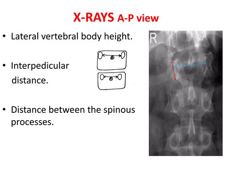 Thoraco Lumbar Fractures Pptx