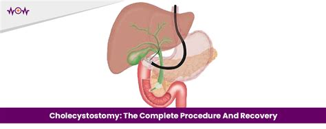 Cholecystostomy The Complete Procedure And Recovery Wow Health