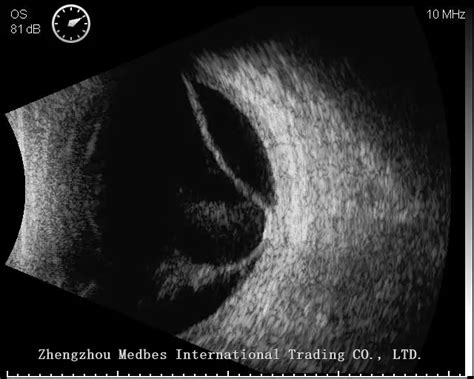 B Scan Ultrasound Ab Scan Ophthalmology Cart And Printer