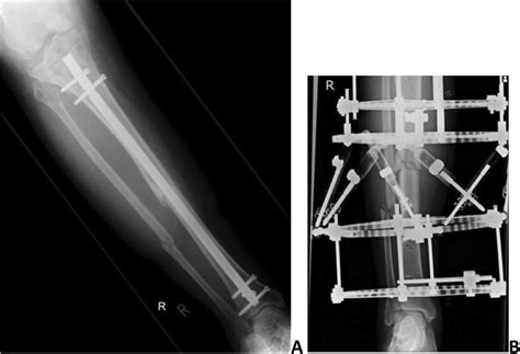A Radiograph Showing Segmental Tibial Fracture Fixation With Imn B Download Scientific Diagram