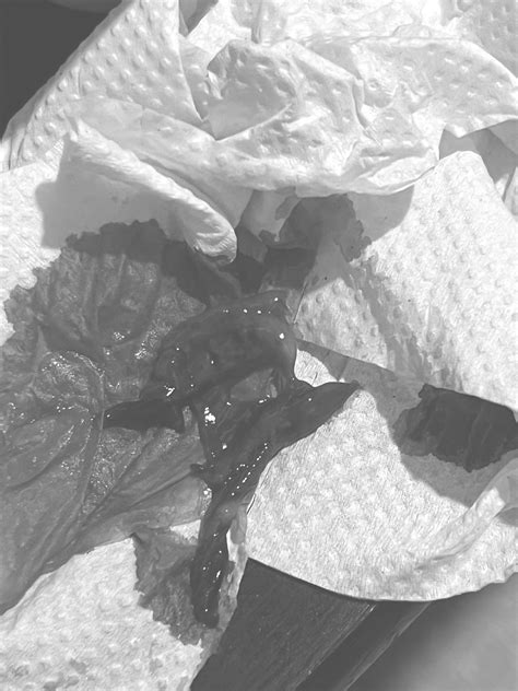 Did I Miscarry Or Is It Just A Normal Clot In My Menstruation R