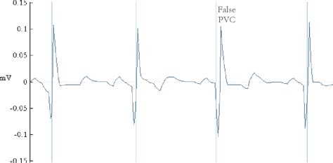 Figure 1 From Algorithm For Premature Ventricular Contraction Detection From A Subcutaneous
