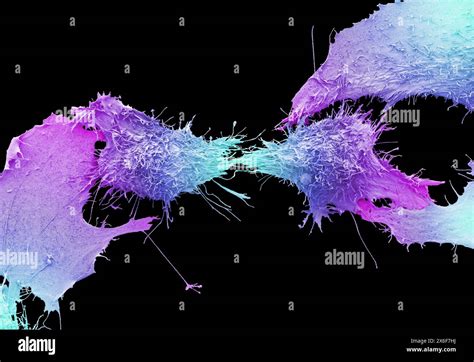 Cervical Cancer Cells Dividing Coloured Scanning Electron Micrograph Sem The Cervix Also