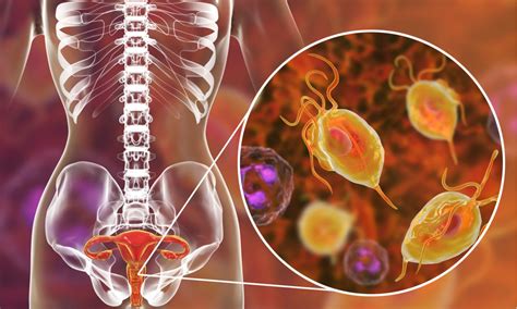 Trichomoniasis Quick Facts Genetrack Biolabs
