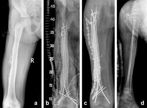 Ewings Sarcoma Femur