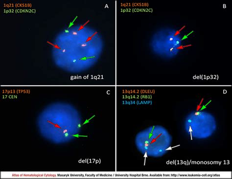 Labcorp Multiple Myeloma Fish At Luis Silva Blog