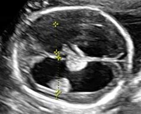 Neonatal Head Ultrasound Ventriculomegaly