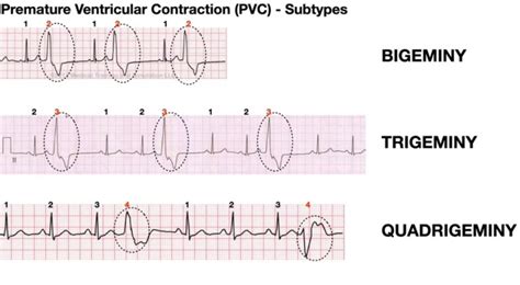 Pvc 의학용어 심실조기수축 Ectopic Bigeminy Trigeminy 개념 공부하기 네이버 블로그