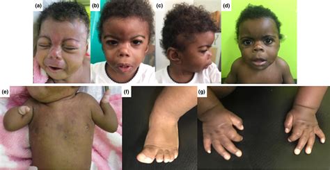 Cornelia De Lange Syndrome Photos Xaxo