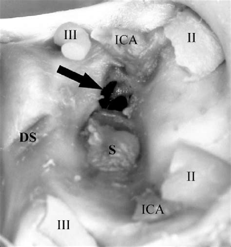The Dural Defect Arrow Located On The Posterior Of The Left Optic