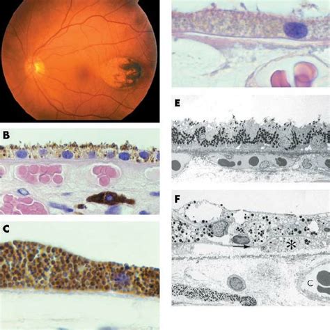 Active Diffuse Anterior Scleritis In The Temporal Quadrant Of The Left Download Scientific