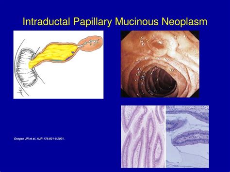 PPT - Intraductal Papillary Mucinous Neoplasms PowerPoint Presentation - ID:4265826