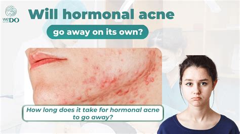 Do Hormonal Acne Go Away On Its Own How Long Does It Take To Heal Wedo