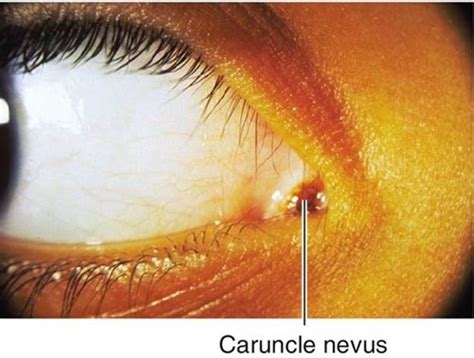 Conjunctiva And Sclera The Massachusetts Eye And Ear Infirmary