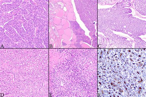 Poorly Differentiated Thyroid Carcinoma A Insular Architecture With