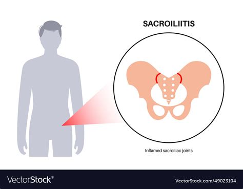 Sacroiliitis Medical Poster Royalty Free Vector Image