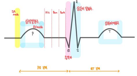 Ecg 기초정리4 심전도 Qrs파의 형성 병적q파 Pathologic Q Wave 전기흐름의 방향 Qrs Duration