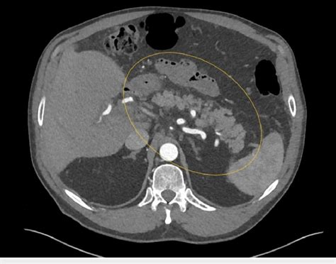 Computed Tomography Angiogram Of The Abdomen And Pelvis Confirms An Download Scientific Diagram