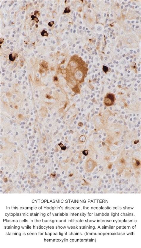 Pathology Outlines Kappa Lambda Light Chains