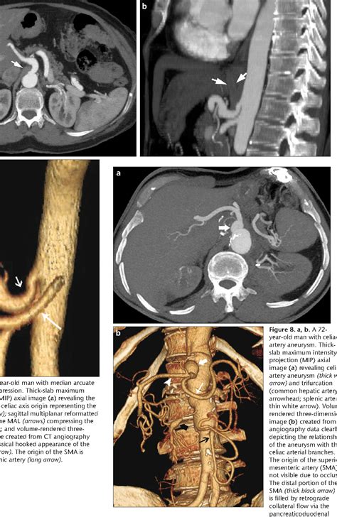 Celiac Artery Angiogram