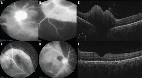 Hiv Retinopathy Oct