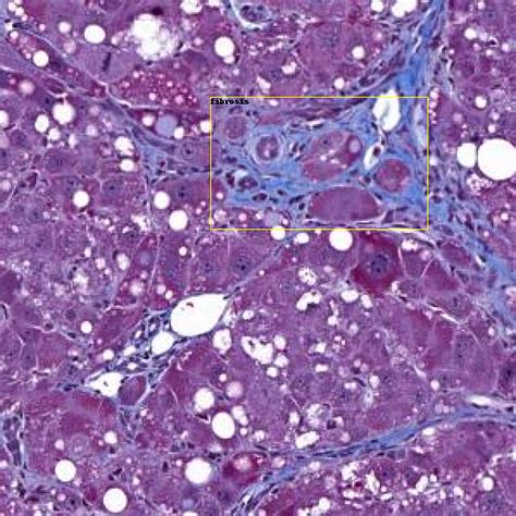 DunnBC22 Yolos Small Liver Disease Hugging Face