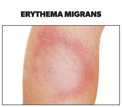 Erythematous Rash