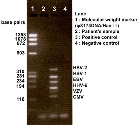 Intraocular Inflammation Following Faricimab Intravitreal Injection Treated With Sub Tenon