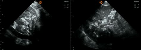 Pocus Finding Of Portal Venous Gas An Unusual Consequence Of An