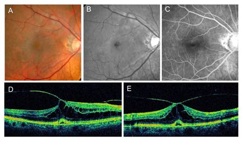 Ophthalmology Notes And Synopses Prepapillary Vascular Loop