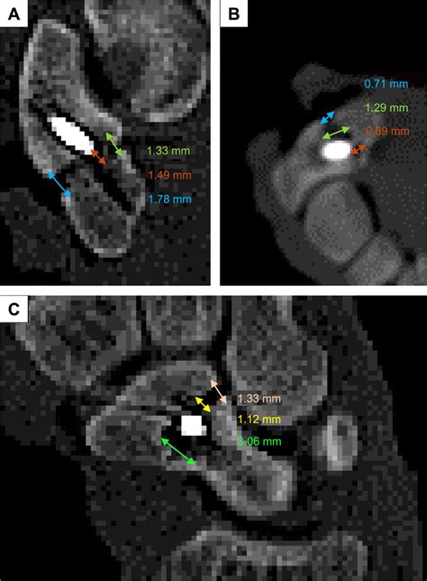 Ct Scanning To Measure Fracture Gap Displacement After Fatigue Testing Download Scientific