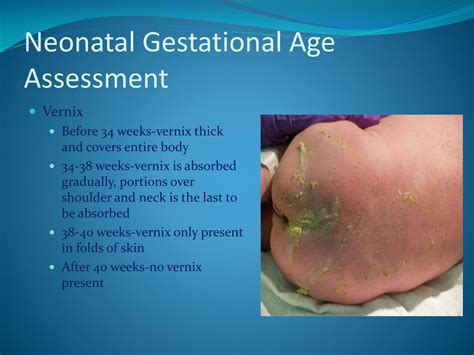 Ppt Neonatal Gestational Age Assessment Powerpoint Presentation Free Download Id353658