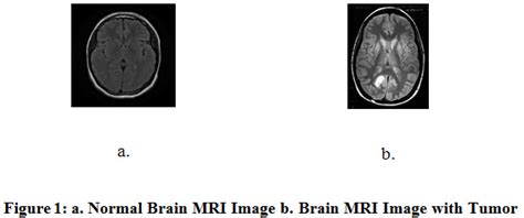 a hybrid method for brain tumor detection using advanced textural
