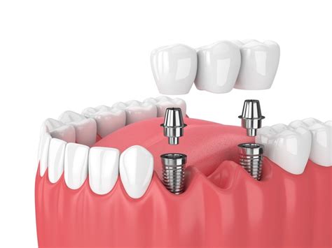 Metallic Root Form Dental Implants For Medical At Rs 25000 Piece In