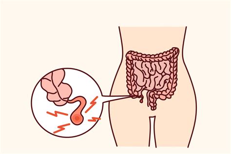 Inflamed Appendix