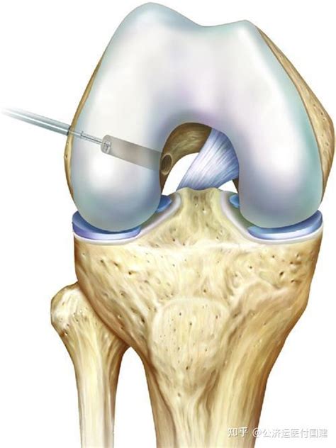 Acl全内重建技术 知乎
