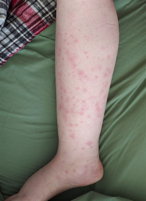 Seeing Red My First Encounter With Cellulitis