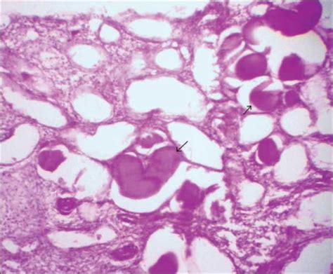Collapsing Glomerulopathy In An Hiv Positive Patient In A Low Incidence