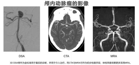 【每周科普】有关颅内动脉瘤，公众最需要知道的10个问题 脑医汇