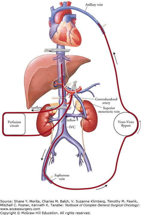 Regional Cancer Therapy Isolation Perfusion Isolation Infusion And