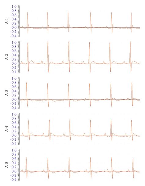Ecg Recordings And Depiction Of The Ecg Parameters Measured A Download Scientific Diagram
