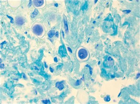 Acanthamoeba Encephalitis A Case Report And Review Of Therapy Pmc