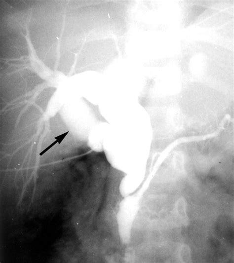 Using MR Cholangiopancreatography To Reveal Anomalous