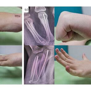 A Year Old Male With Fracture Of The Fourth And Fifth Metacarpal Download Scientific