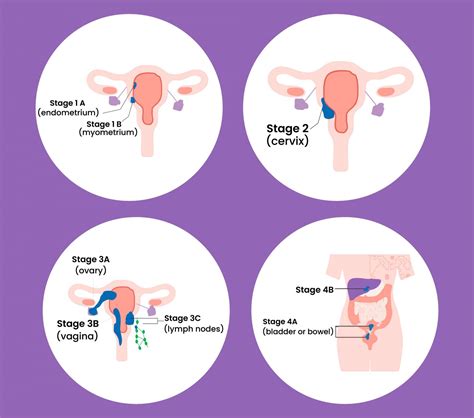 What Is Endometrial Cancer Its Symptoms Stages Etc