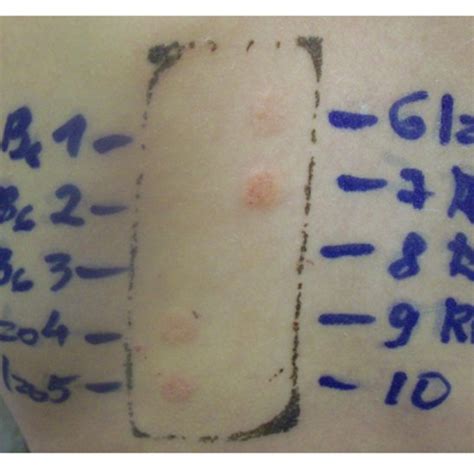 Skin Patch Test After 168 H Follow Up After 5 Years Download Scientific Diagram