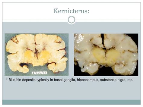Ppt Neonatal Hyperbilirubinemia Powerpoint Presentation Free
