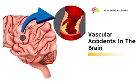 Vascular Accidents In The Brain Brain Health And Puzzles